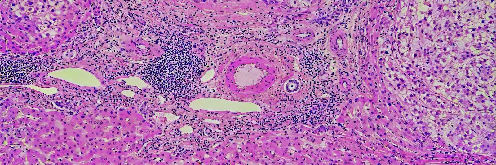 Histological Imaging and Analysis to Assess Disease Progression and ...
