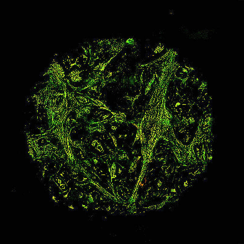 H&E stained Human TMA core imaged with a 488 nm laser | Galleries ...