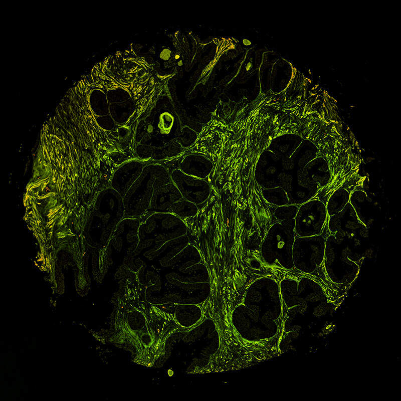 H&E-stained TMA core of human prostate tissue | Galleries | Nikon ...