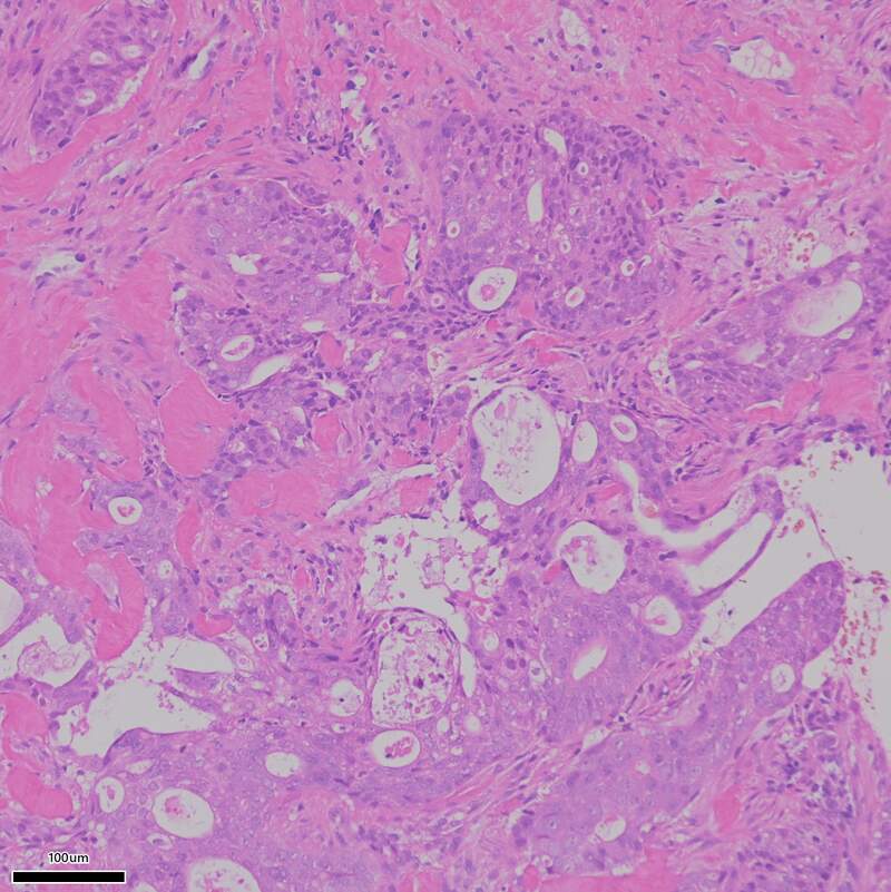 Breast Cancer - HE Staining (20X) | Galleries | Nikon Europe B.V.