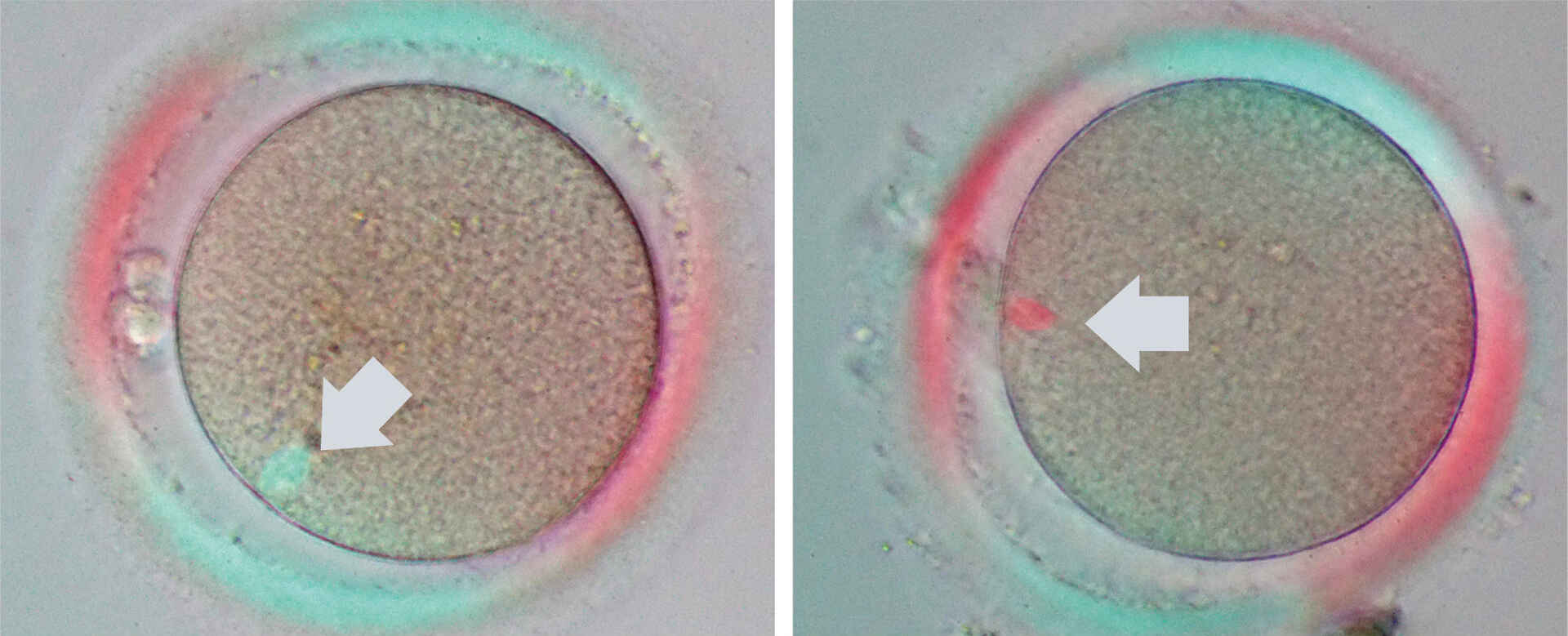 Improvement of ICSI Accuracy by Spindle Visualization | Application ...