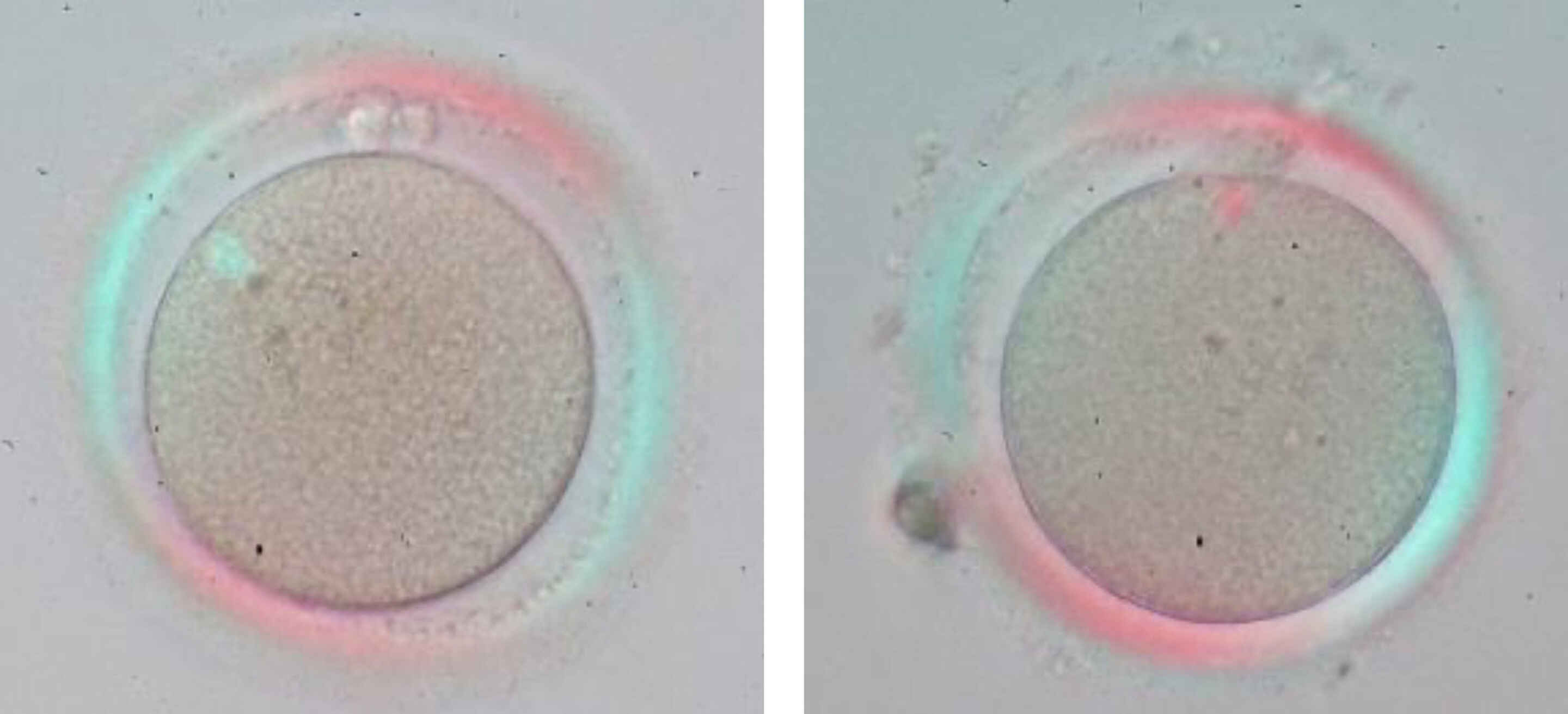 Improvement of ICSI Accuracy by Spindle Visualization | Application ...