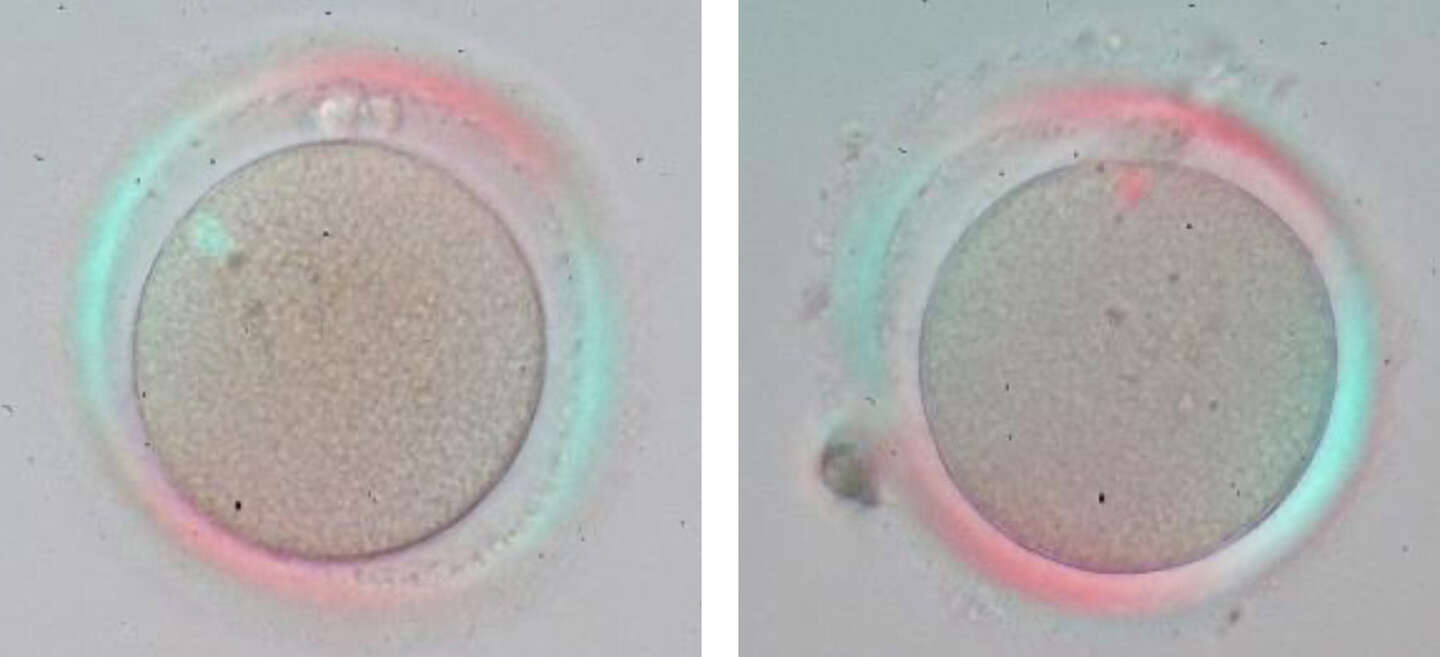 Improvement of ICSI Accuracy by Spindle Visualization | Application ...