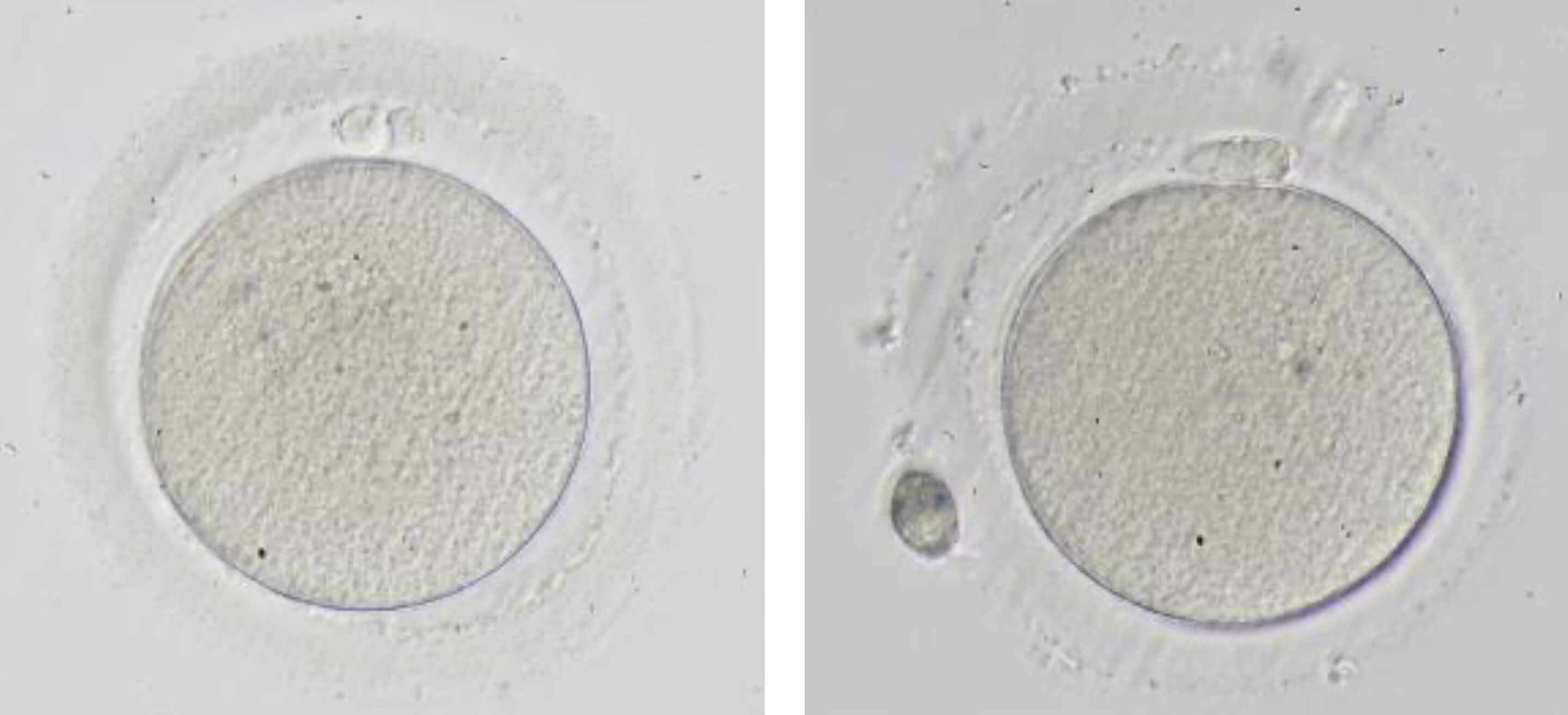 Improvement of ICSI Accuracy by Spindle Visualization | Application ...