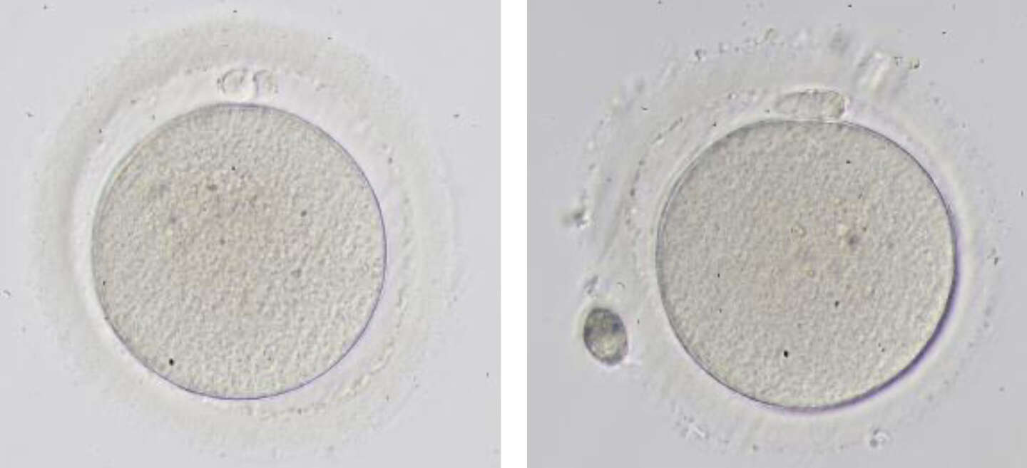 Improvement of ICSI Accuracy by Spindle Visualization | Application ...