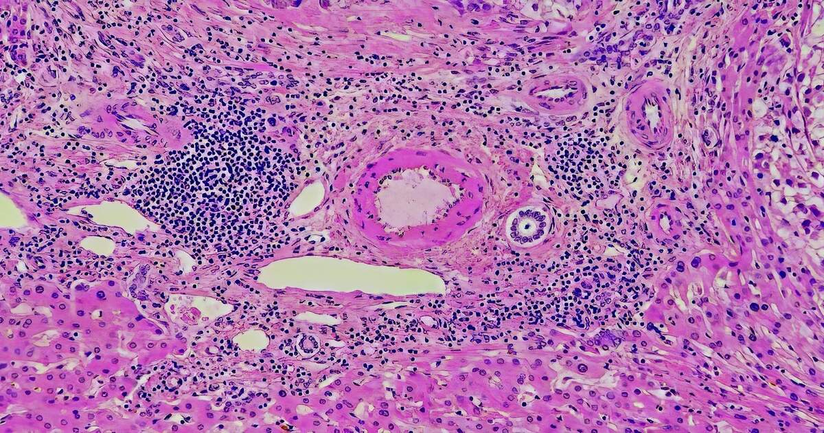 Histological Imaging and Analysis to Assess Disease Progression and ... Histological Imaging and Analysis to Assess Disease Progression and ...